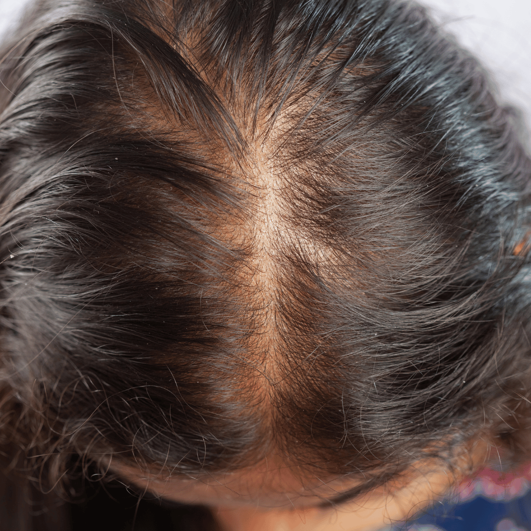 Hair Conditions – The Institute of Trichologists