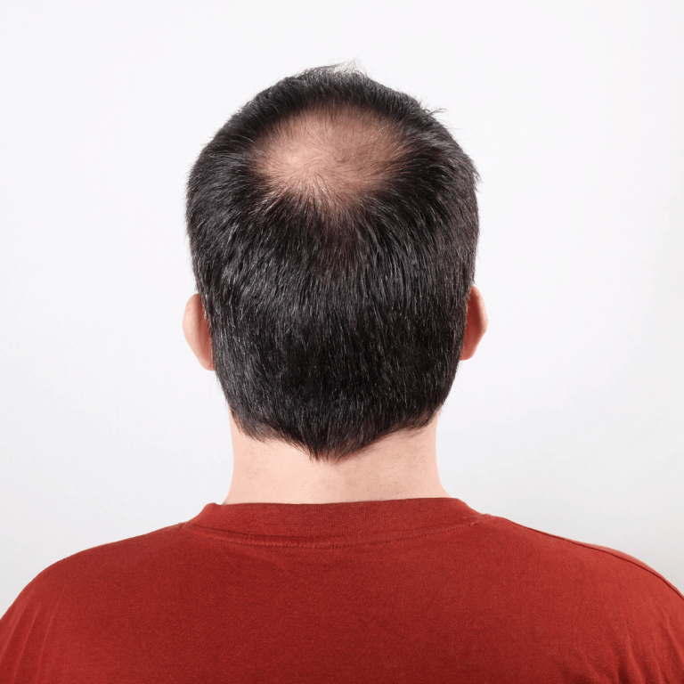 Hair Conditions – The Institute of Trichologists