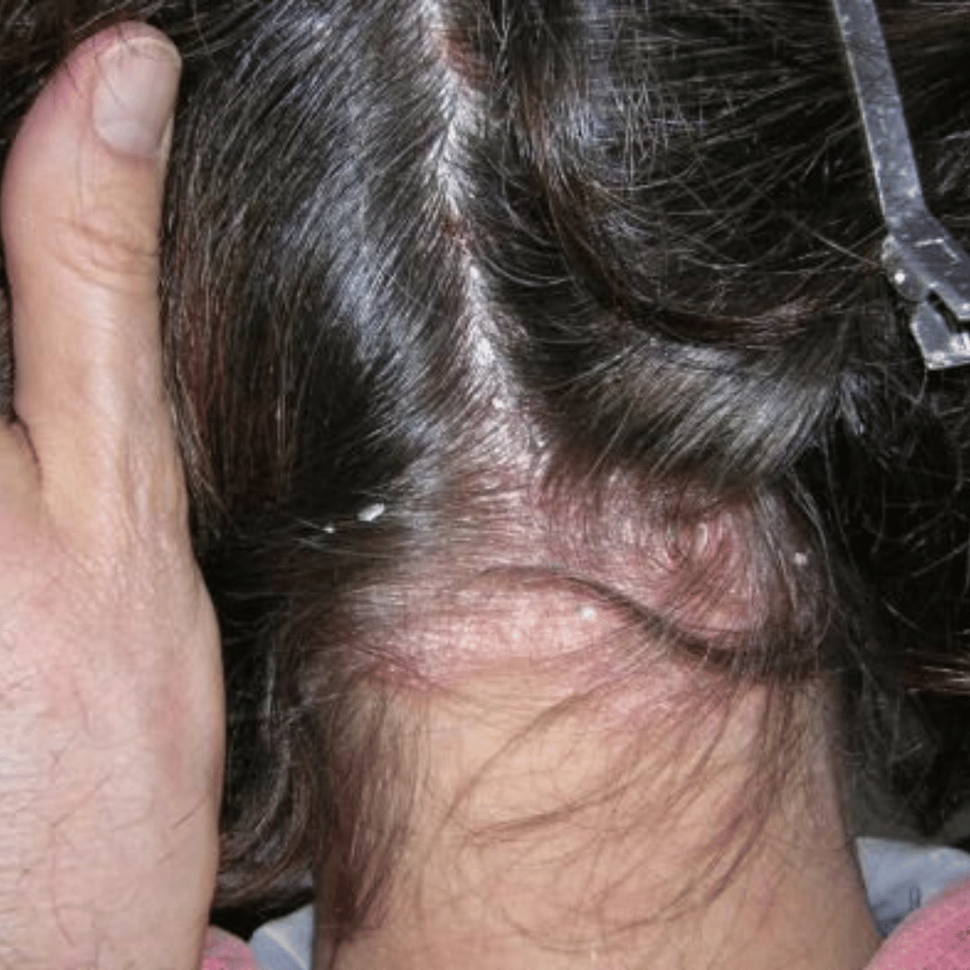 Scalp Conditions – The Institute of Trichologists